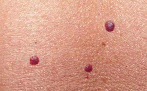 Por qué aparecen puntos rojos en la piel y qué hay que hacer - Mendoza Post