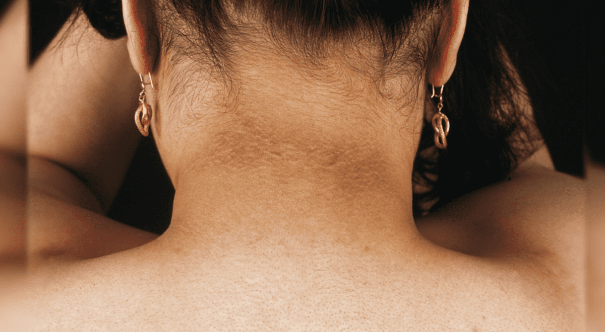 Manchas En El Cuello