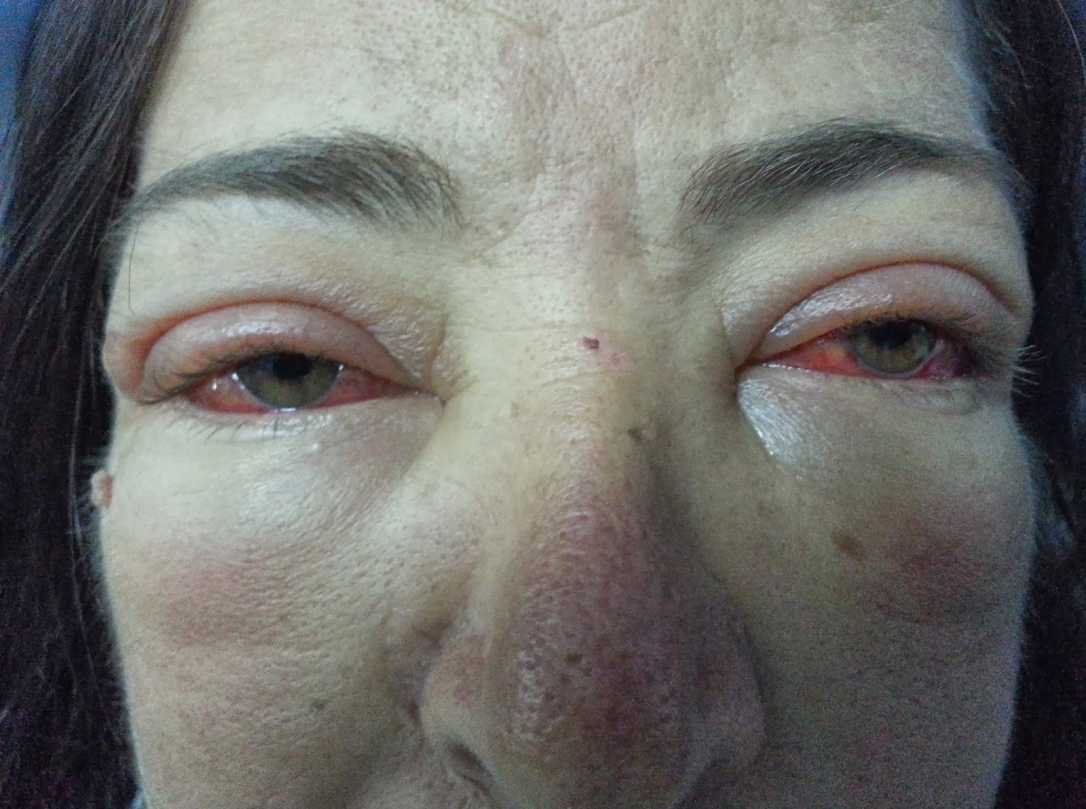 Preocupa nuevo brote de triquinosis con coletazos en Mendoza - Mendoza Post