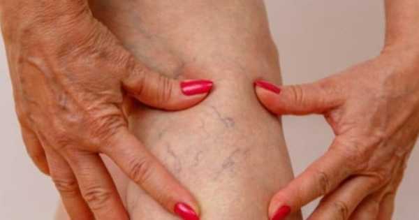 Seis consejos para el alivio de los dolores por várices - Mendoza Post