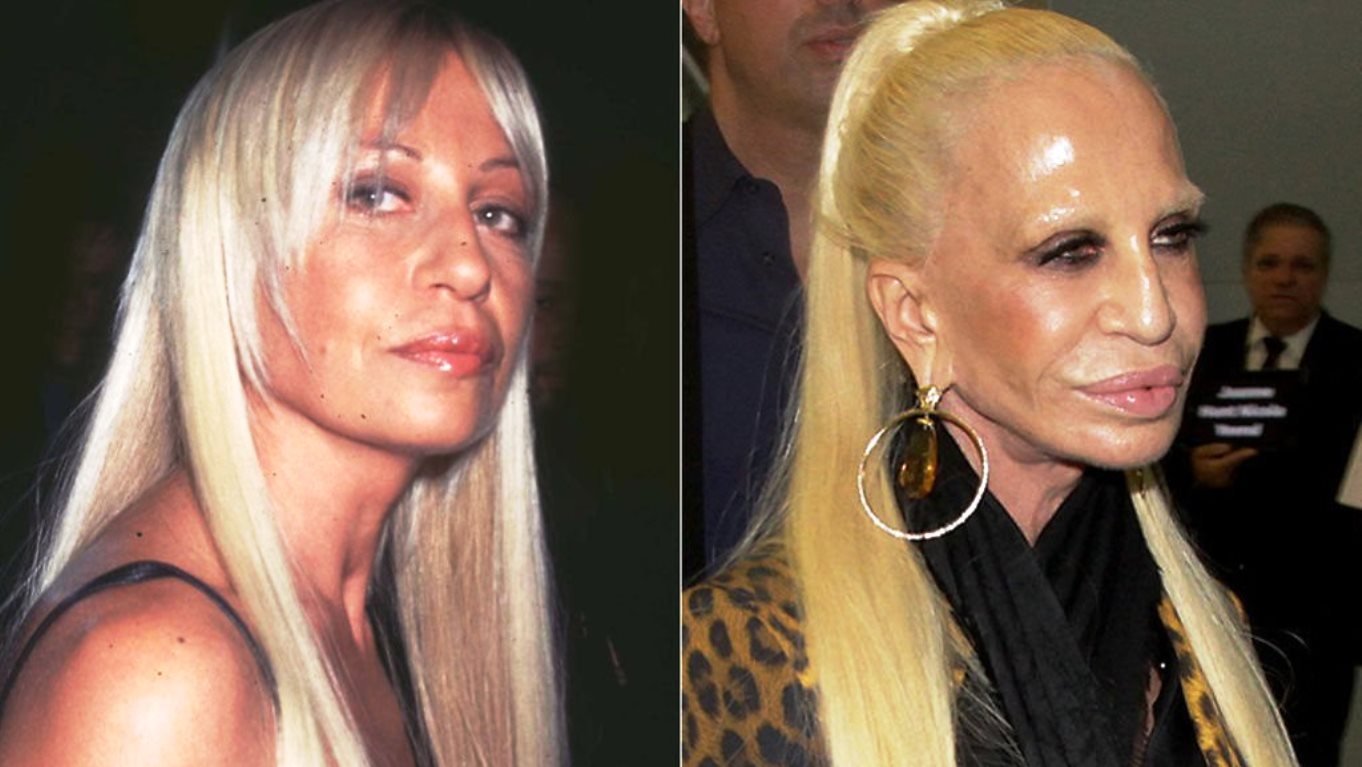 Famosas que se "zarparon" con el botox en los labios - Mendoza Post